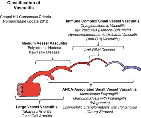 Classification Of Vasculitis Medizzy