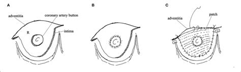 The Technical Details Of Sinus Replacement A Showed The Intima Of Download Scientific