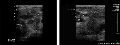 Ultrasonography Of Neck Showed Multinodular Goiter On Left Thyroid Download Scientific Diagram