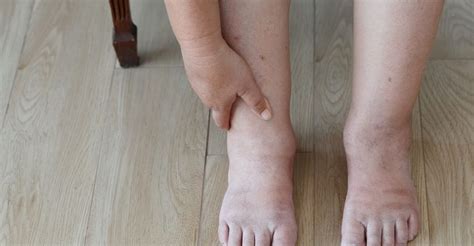 Peripheral Edema Symptoms And Natural Treatments Well Being Secrets