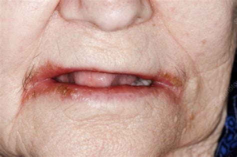 Angular Stomatitis Of The Lips Stock Image C0090062 Science