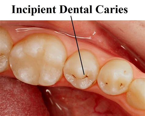 What Is Incipient Caries News Dentagama