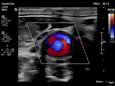 Arterial Cannulation Near Miss During Jugular Venous Cathete Aanda Practice