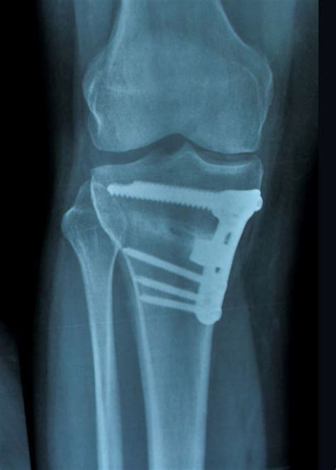 Derotational Osteotomy Pigeon Toe Treatment Surgeon Los Angeles