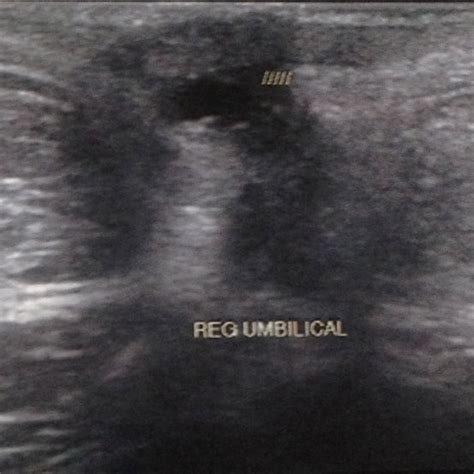 Endometriose Umbilical Aspecto Clínico Nódulo Umbilical Registrado No