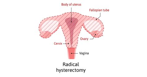 Radical Hysterectomy Benefits Procedure Side Effects And Costs