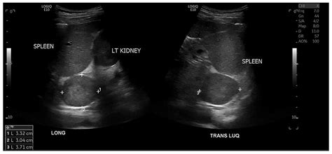 Pheochromocytoma In A Pediatric Patient A Case Report Amanda Nedwick