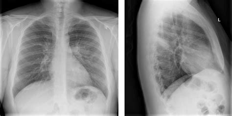 Interpreting Chest X Rays Taming The SRU