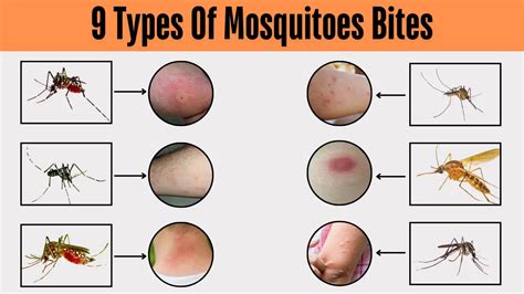 5 Danger Signs When To Worry About A Mosquito Bite