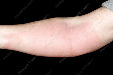 Wasp Sting Reaction Stock Image C0580820 Science Photo Library