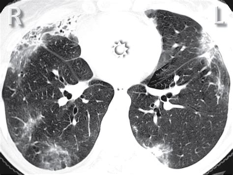 Computed Tomography Of Diffuse Lung Diseases And Solitary Pulmonary