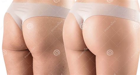 Nalgas Femeninas Antes Y Después Del Deporte Y Del Tratamiento Imagen