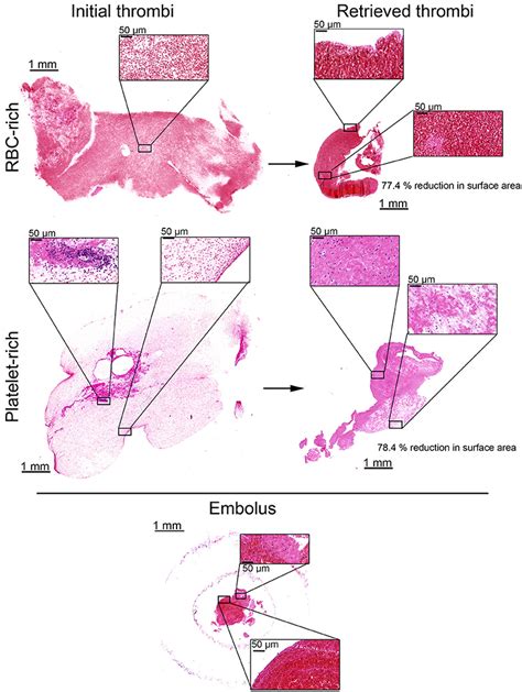 Frontiers Modeling Large Vessel Occlusion Stroke For The Evaluation