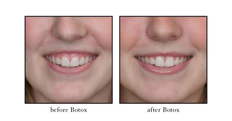 Trusted Botox Experts Atlantic Beach Serene