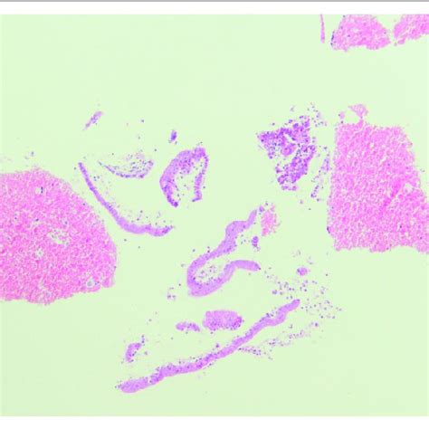 Endometrial Sample Showing Limited Endometrial Tissue Comprising Less