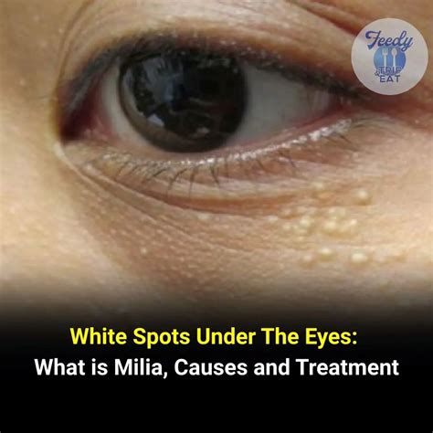 White Spots Under The Eyes Heres What Milia Really Is — Causes Risks