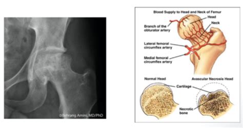 Pt 677 Intra Articular Hip Pathologies Flashcards Quizlet