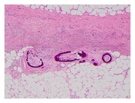 Characteristic Biopsy Specimen Of Cua Demonstrating Circumferential