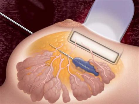 Breast Pathology Consultation Lumpectomy Large Biopsy Stellar Pathology