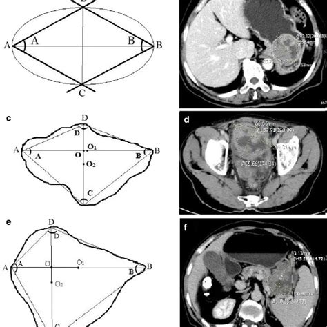 Two Dimensional Schematic Diagram And Actual Tumor Measurement Picture Download Scientific