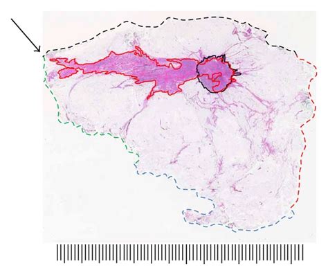 Large Format Section Of Lumpectomy Specimen From Figure 9 Analysis Of Download Scientific