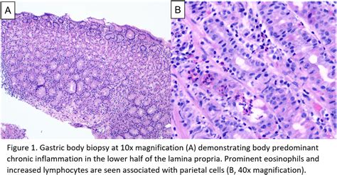 626 Prospective Evaluation Of Earlyevolving Autoimmune Metaplastic