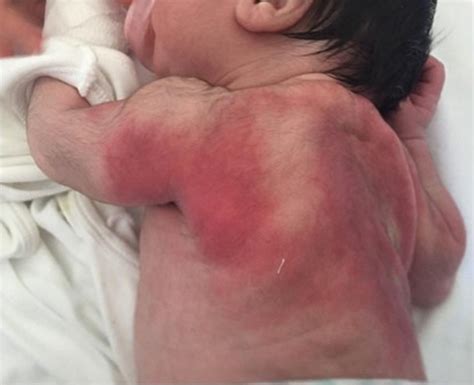 Subcutaneous Fat Necrosis Of The Newborn An Atypical Case With