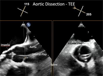 Ultrasound Of The Aorta Cardiology Clinics