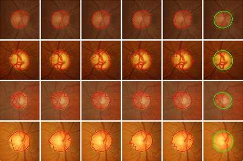 Optic Disc Segmentation In Drishti Gs With Different Numbers Of