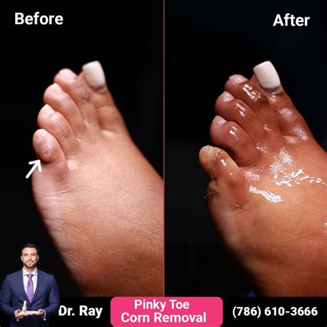 Permanent Callus And Corn Removal Surgery