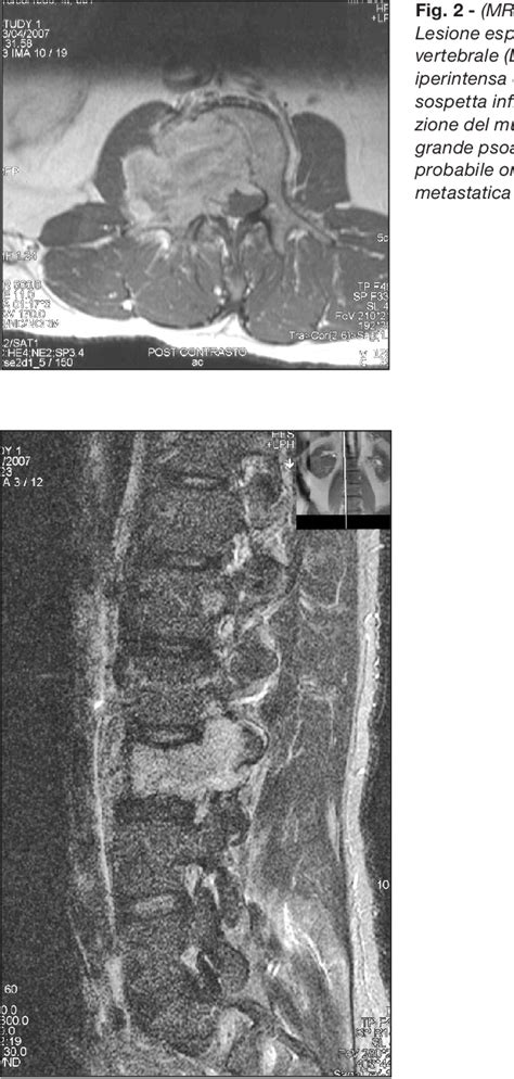 Figure 2 From Batsons Paravertebral Venous Plexus And Single Vertebral