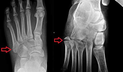Fractura De Jones Doctor Iborra