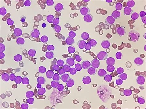 Fotos Trombocitopenia 60 Fotos De Arquivo Grátis De Alta Qualidade