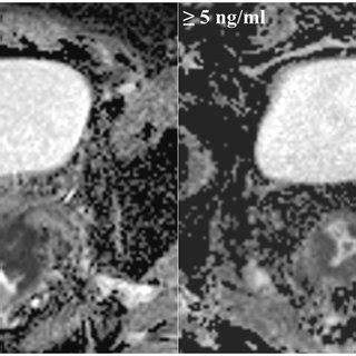 Different Clinical T Stage Of Tumors And Corresponding ADC Maps Download Scientific Diagram
