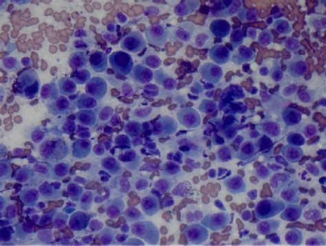 Pleural Fluid Malignant Mesothelioma Cytospin Diff Quik Stain High Download Scientific