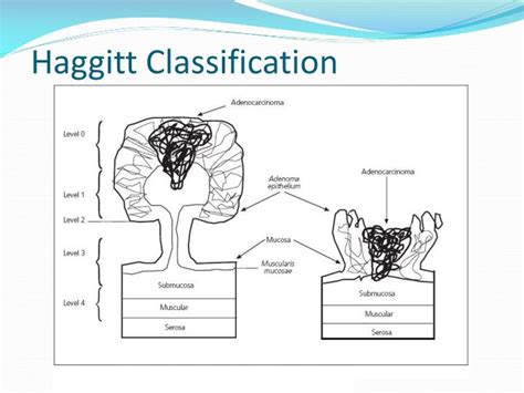 Ppt Treatment Of Early Malignant Rectal Polyp Powerpoint Presentation Id1435210