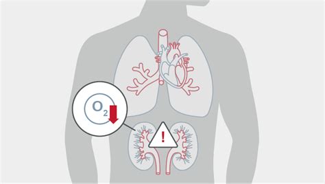 Shock Management Edwards Lifesciences