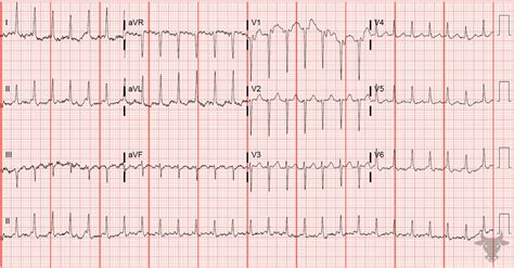 Atrial Flutter Ecg Stampede