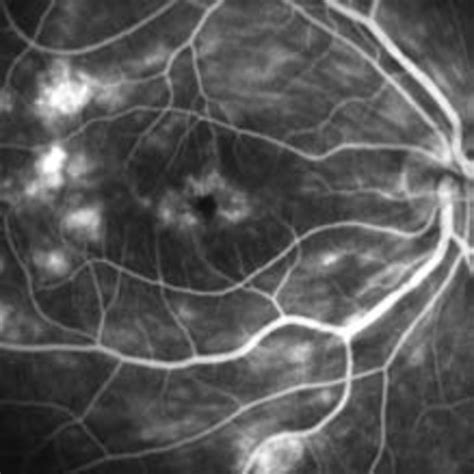 Conventional Angiograms All Read As “ Consistent With Vasculitis ” A