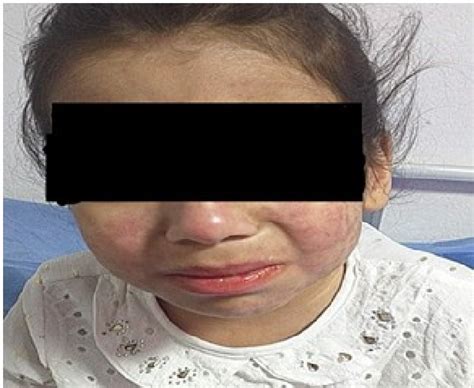 Older Babe Presented With Malar Rash Download Scientific Diagram