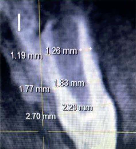 Preoperative Clinical Revascularization Procedure And Radiographic Download Scientific Diagram