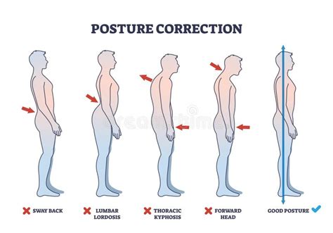 Posture Correction Diagram Shows Five Side View Silhouettes