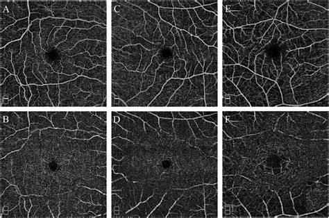 Ophopedia Retinal Microvascular Density And Vascularity After Iac Ophthopedia Posted On The