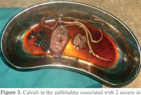 Figure 3 From Gallbladder Ascariasis Semantic Scholar