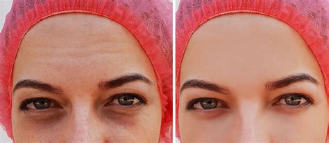 Negative Canthal Tilt The Ultimate Guide Meaning Fix Vs Positive