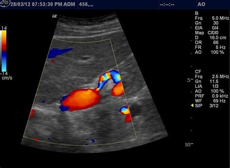 Median Arcuate Ligament Syndrome Eurorad