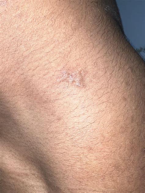 Itchy Rash That Leaves Scars At Nathaniel Birge Blog