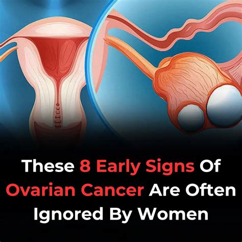 8 Early Warning Signs Of Ovarian Cancer You Shouldnt Ignore
