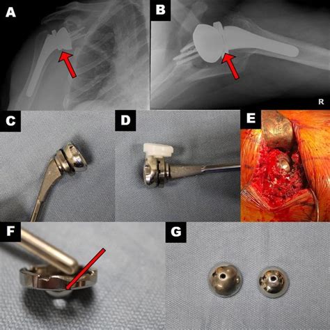 A 60 Year Old Male With Reverse Shoulder Arthroplasty Dislocation Download Scientific Diagram