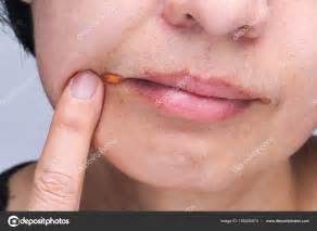 Queilitis Angular Vs Herpes Labial Angular Cheilitis Vs Lupus Rash 4